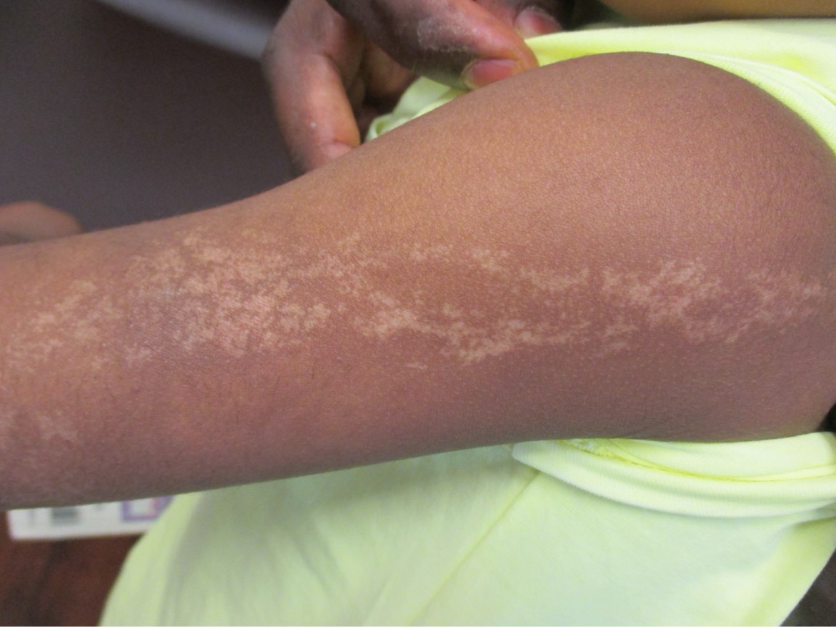 An Atlas of Lumps and Bumps, Part 38: Lichen Striatus | Consultant360